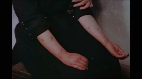 1940s: View of scars on woman's arms. Wo... | Stock Video | Pond5