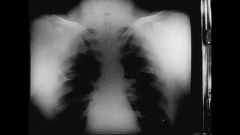 1950s - An X-ray, surgery, radioactive m... | Stock Video | Pond5
