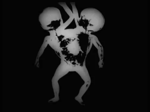 1957 An xray of conjoined twins attache... | Stock Video | Pond5