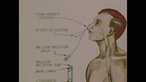1960s: Illustration of Levin Tube insert... | Stock Video | Pond5