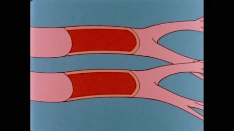 1980s: Animation of plaque forming in th... | Stock Video | Pond5