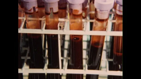 1980s: Vials of blood sit in rack. Woman... | Stock Video | Pond5