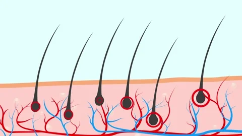 2D animation of hair loss proceeded by n... | Stock Video | Pond5