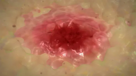 3D animation of the Gastric ulcer, 4K Ul... | Stock Video | Pond5