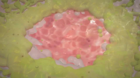3D animation of the Gastric ulcer, 4K Ul... | Stock Video | Pond5