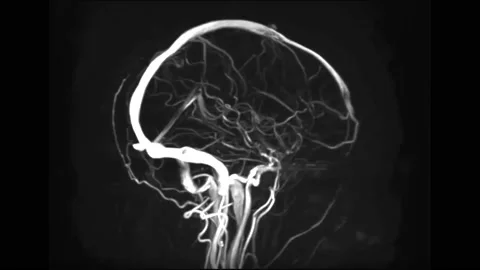 3D Brain MRI Angiography (Magnetic Reson... | Stock Video | Pond5
