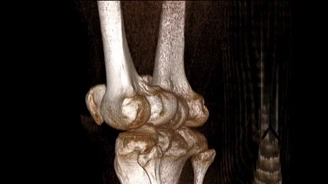 3D CT Scan of Knee Joint with Rotating I... | Stock Video | Pond5