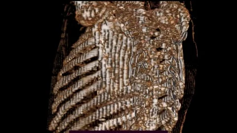 3D CT Scan of Lumbar Spine with Rotating... | Stock Video | Pond5