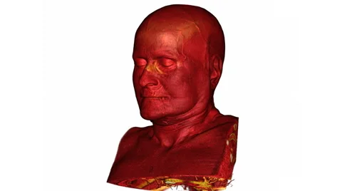 3D CT scan reconstruction of the head an... | Stock Video | Pond5