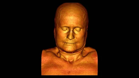 3D CT scan reconstruction showing the he... | Stock Video | Pond5