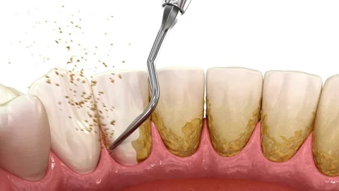 Dental Animation Stock Footage ~ Royalty Free Stock Videos | Pond5