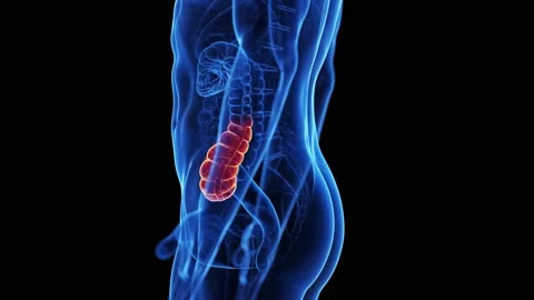 3d medical animation of a colon sufferin... | Stock Video | Pond5