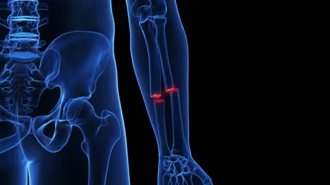 3d medical animation of a fracture of th... | Stock Video | Pond5