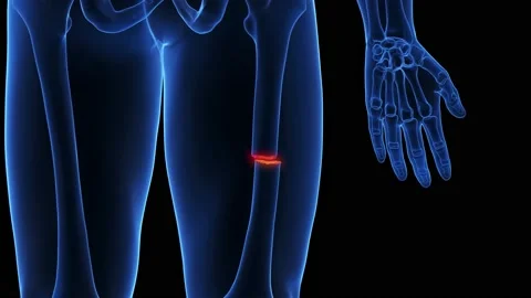 3d medical animation of a fracture of th... | Stock Video | Pond5