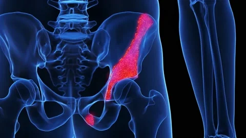 3d medical animation of a fracture of th... | Stock Video | Pond5