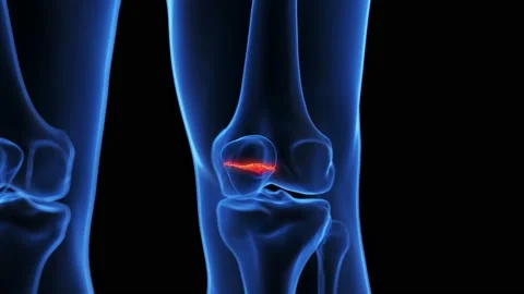 3d medical animation of a fracture of th... | Stock Video | Pond5