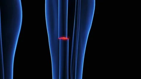 Fracture Stock Video Footage | Royalty Free Fracture Videos | Pond5