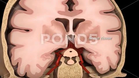 3D medical illustration of brain injury: Graphic #220013605