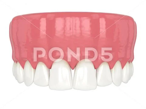 3d render of human upper jaw with black triangles Illustration #140600148