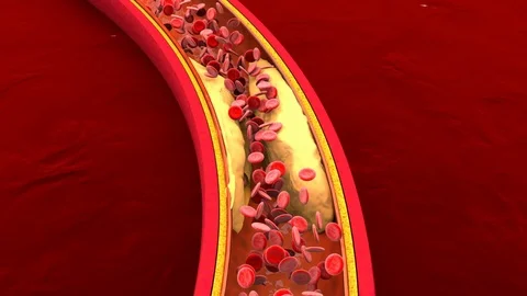 Clogged Arteries Stock Footage ~ Royalty Free Stock Videos | Pond5