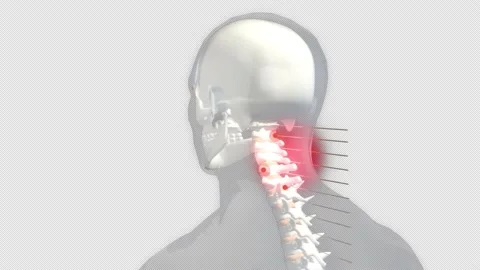 3d rendered animation of a painful neck.... | Stock Video | Pond5