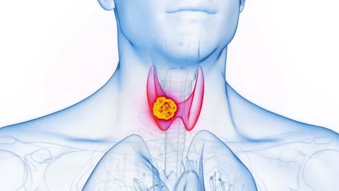 3d rendered medical animation of cancer ... | Stock Video | Pond5