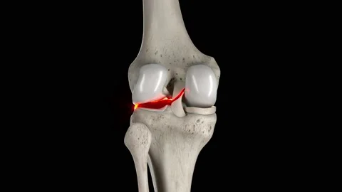 Meniscus Stock Video Footage | Royalty Free Meniscus Videos | Pond5