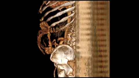 3D Rotating View of Abdomen CT Scan: Det... | Stock Video | Pond5