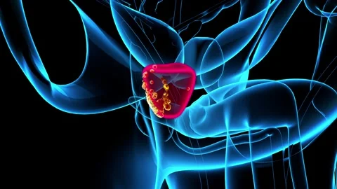 Prostate Cancer Stock Video Footage | Royalty Free Prostate Cancer ...