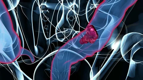 4K abstract animation of the colon cance... | Stock Video | Pond5