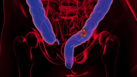 4K abstract animation of the colon cance... | Stock Video | Pond5