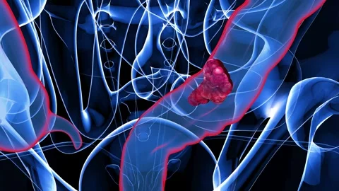 4K abstract animation of the colon cance... | Stock Video | Pond5