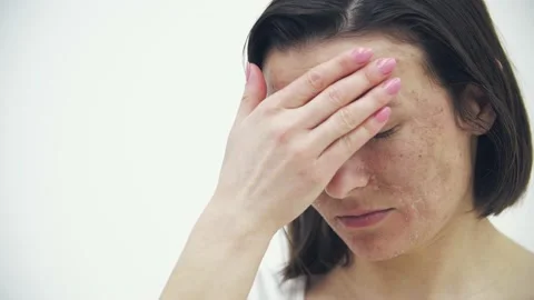 Melasma Stock Footage ~ Royalty Free Stock Videos | Pond5