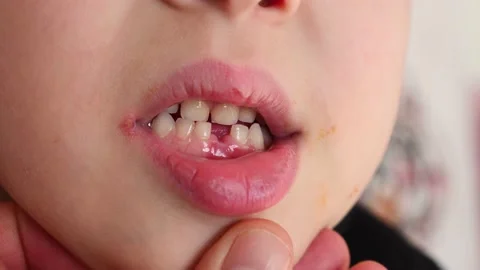 7-year-old child's primary tooth loss, a... | Stock Video | Pond5