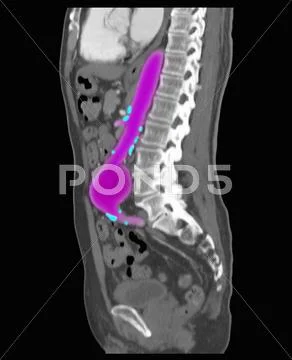 Abdominal angiographic CT scan showing a large abdominal aortic ...