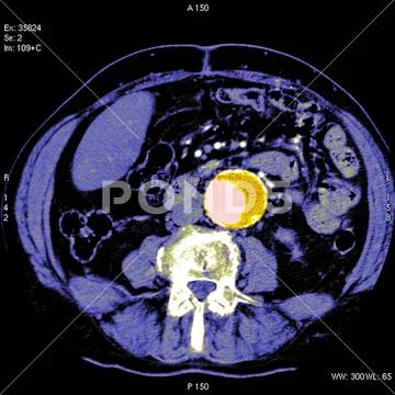 Abdominal aorta aneurysm, scan Axial CT scan. Aneurysm shown in yellow ...