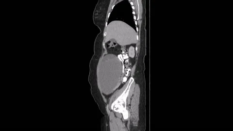 Abdominal cyst, CT scan | Stock Video | Pond5