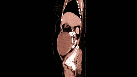 Abdominal cyst, CT scan | Stock Video | Pond5