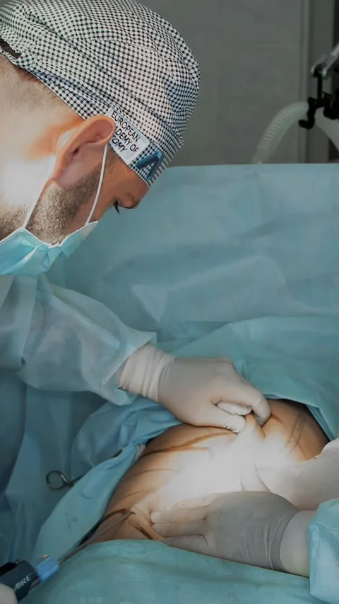 Liposuction Surgeons Stock Videos – Royalty-Free HD & 4K Videos