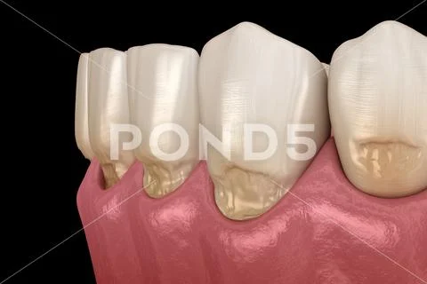Abfraction of anterior teeth. Medically accurate 3D illustration ...