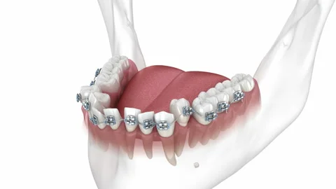 Abnormal teeth position and correction w... | Stock Video | Pond5