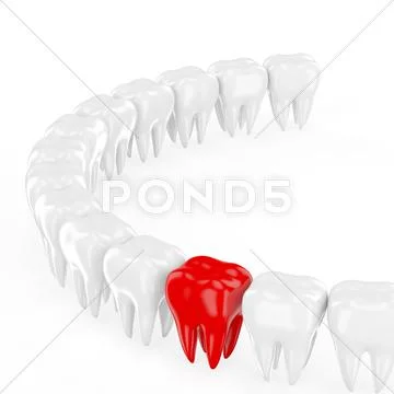 Aching tooth in row of healthy teeth. 3d: Graphic #39520925