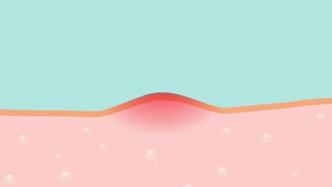 Acne and Pimples, stages of development,... | Stock Video | Pond5