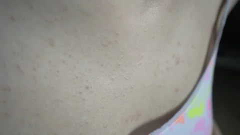 Acne on girl's chest, skin problems | Stock Video | Pond5