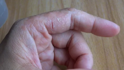 Acute Atopic Dermatitis Eczema Rashes | Stock Video | Pond5