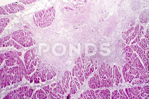 Photograph: Acute myocardial infarction, histology of heart tissue ...