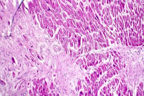 Acute myocardial infarction, histology of heart tissue ~ Premium Photo ...