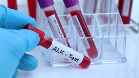 ALK test to look for abnormalities from ... | Stock Video | Pond5