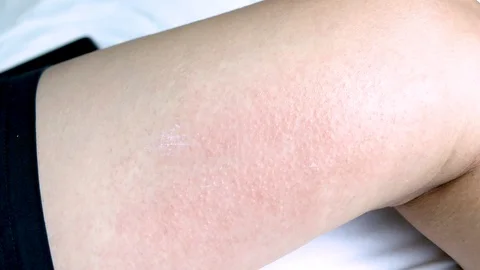 Allergic rash dermatitis eczema on skin. | Stock Video | Pond5