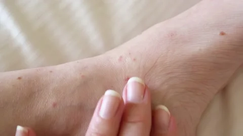 Allergic rash dermatitis leg skin, red a... | Stock Video | Pond5